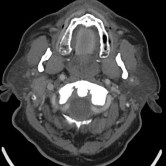 Pathology Through Anatomy—Imaging the Suprahyoid Neck Spaces
